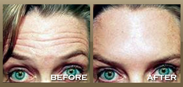 Skinnpeccable | Botox® | Los Angeles