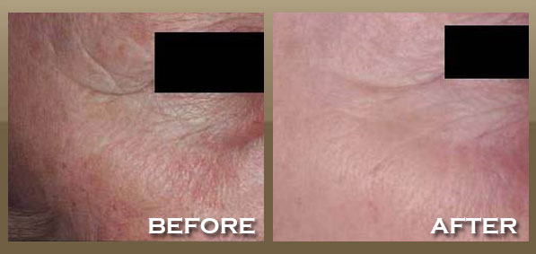 IPL Photofacial Brentwood, West Hollywood, LA |Skinpeccable