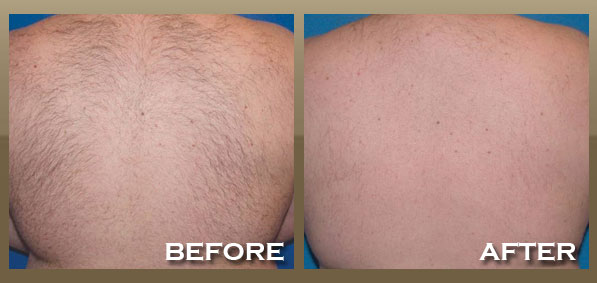 Laser Hair Removal West Hollywood