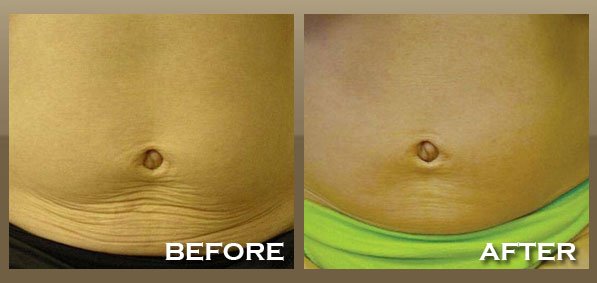 laser-skin-tightening-stomach - Skinpeccable