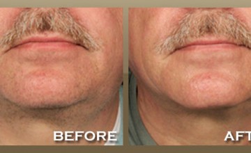 Skinpeccable | Loose Skin | Los Angeles