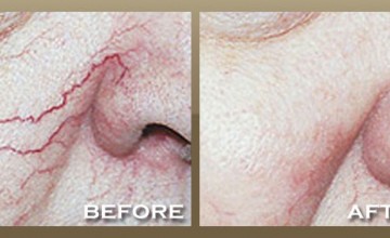 Skinpeccable | Spider Veins | Los Angeles